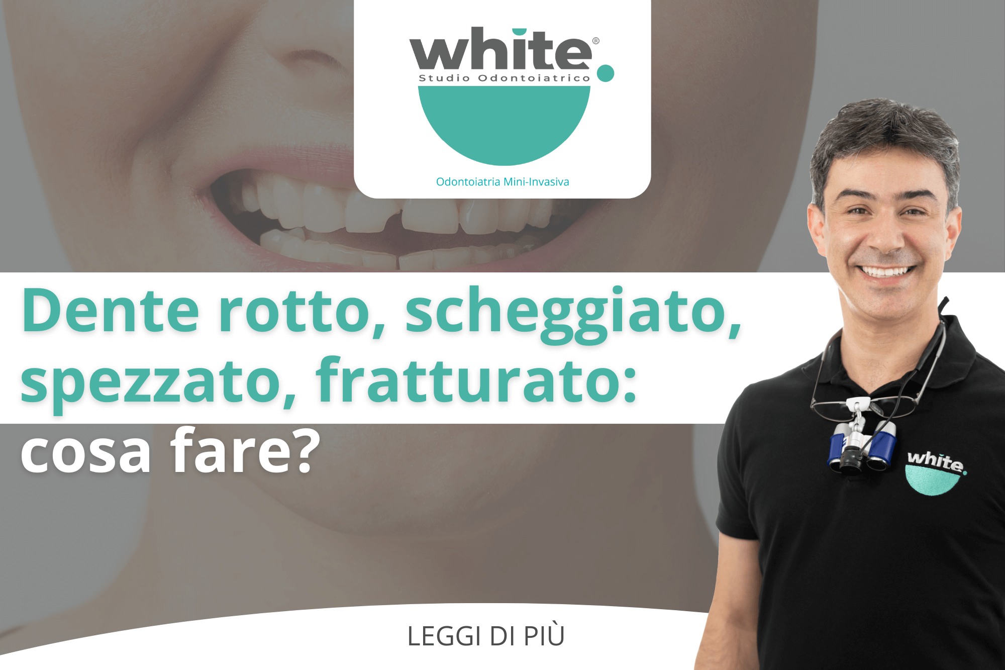 Dente rotto, scheggiato, spezzato, fratturato: cosa fare? - White Cagliari